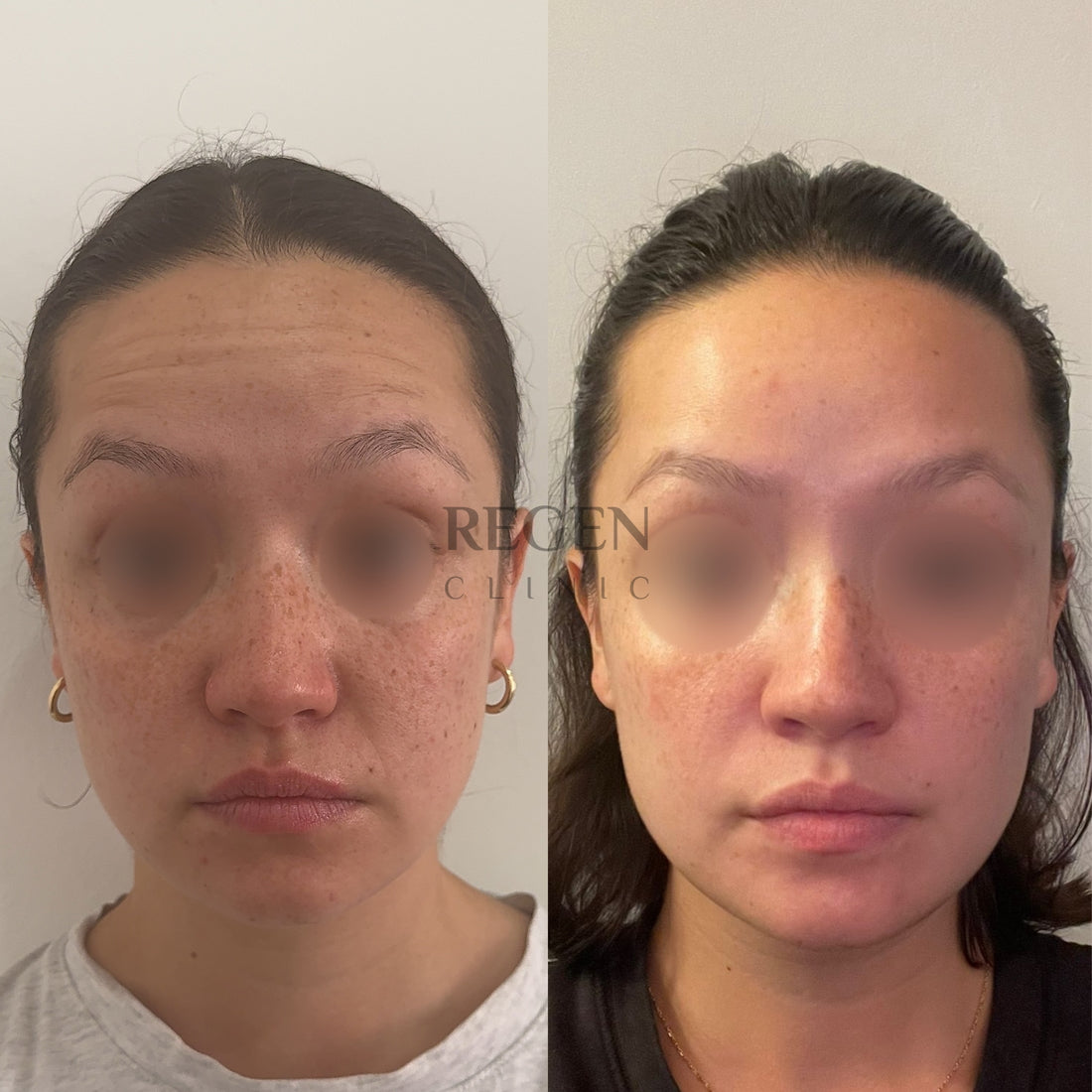 Textured Skin – REGEN Clinic